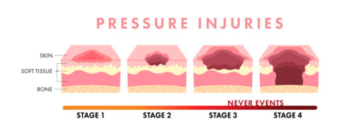 Pressure Injuries: Never Events - Part 1 - Action Products